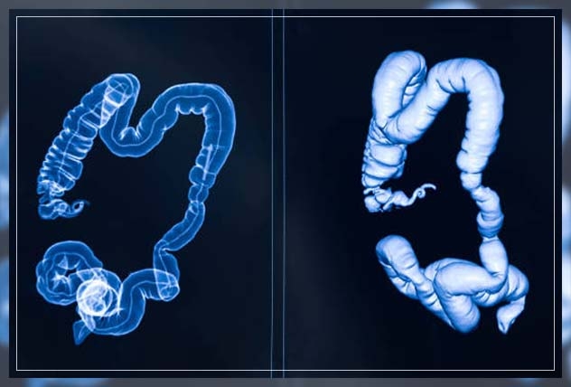 Crohn's Disease: A Complete Guide - REPC