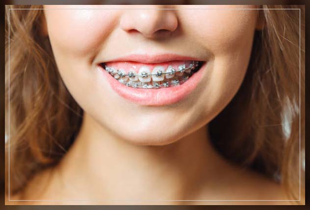 Are Ceramic Braces Right for You? - REPC