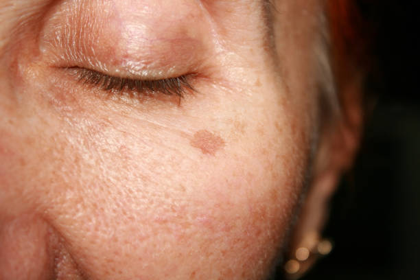 Dark Spots on Face: Causes and Treatment - REPC