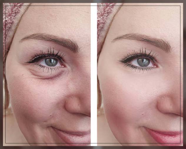 Puffy Eyes: Causes and Remedies - REPC