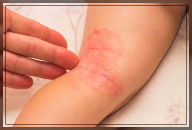 Fungal Skin Rash On Back