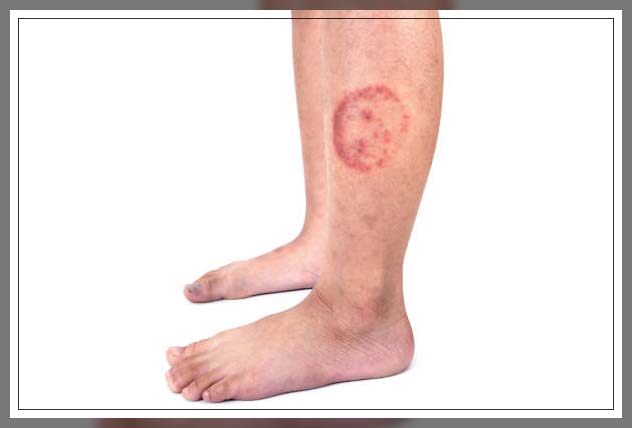 Overview of Fungal Skin Infection - REPC
