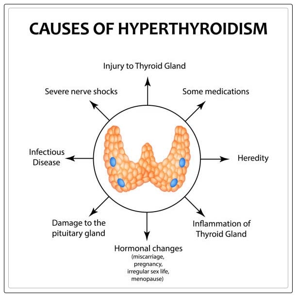 Hyperthyroidism: Symptoms, Causes, and Treatment - REPC