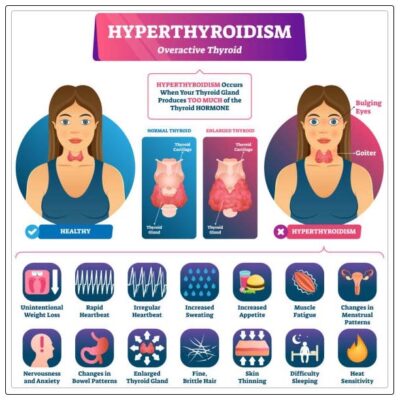 Hyperthyroidism: Symptoms, Causes, and Treatment - REPC