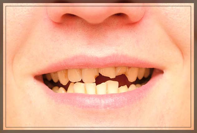 Tooth Fractures: Causes, Types and Prevention - REPC