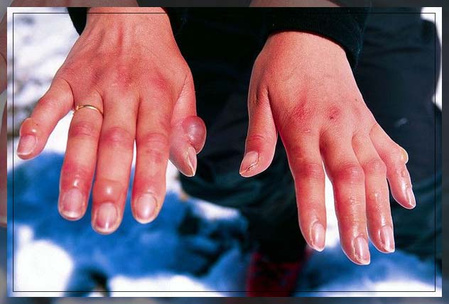 Frostbite Symptoms - REPC