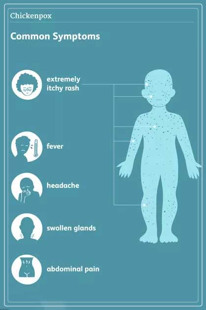 Chicken Pox: Symptoms, Causes, Stages, and More - REPC