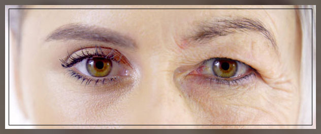 Droopy Eyelids: How to Fix? - REPC