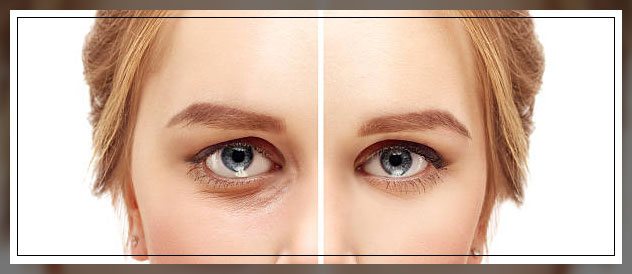 Droopy Eyelids: How to Fix? - REPC