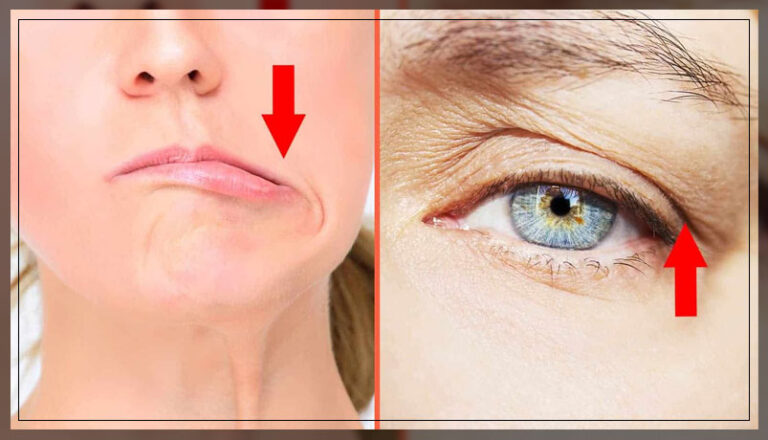 Botox Side Effects: When to Stop? - REPC